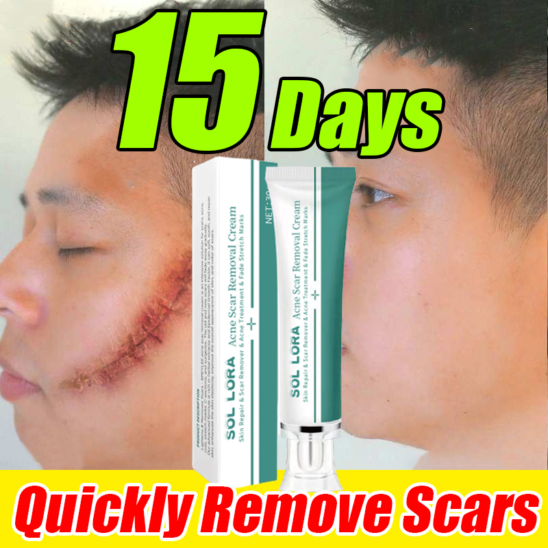 Scar Removal Cream Suitable For New And Old Scars To Promote Natural ...