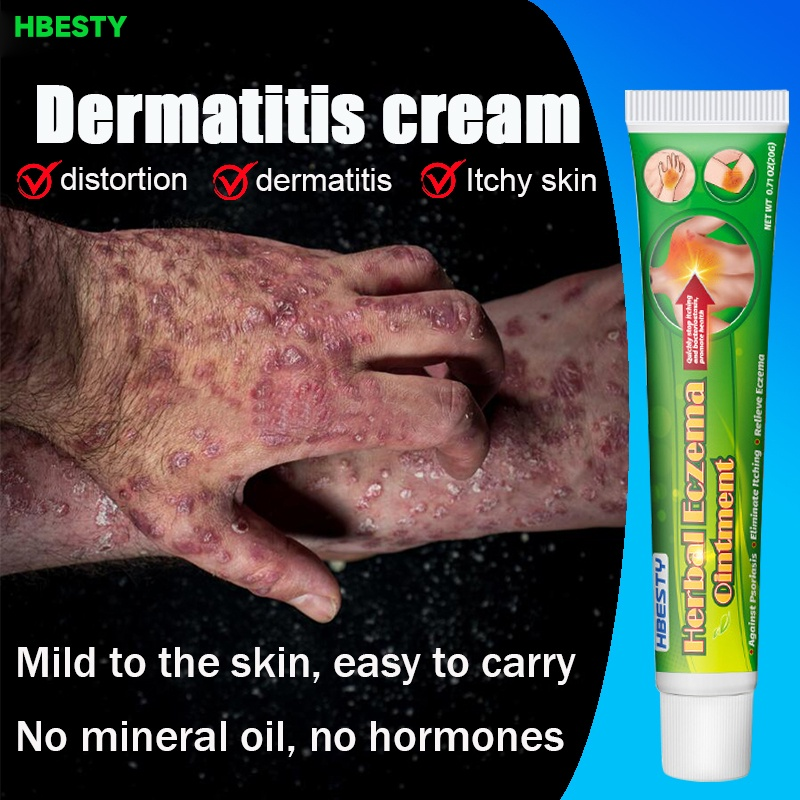 Antifungal Cream 20g Psoriasis Eczema Ointment Treatment Cream Solution ...