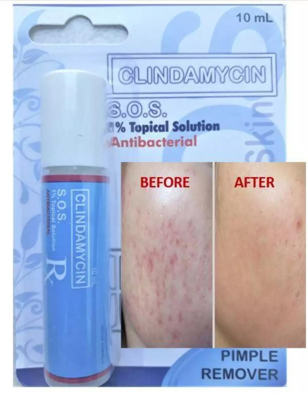 [Kelvin Online Preferred] ORIGINAL 100% S.O.S Clindamycin Phosphate ...