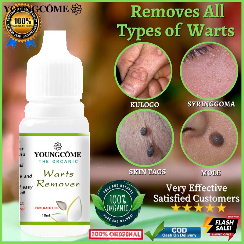 Warts Remover Original Warts Removal Kulogo Remover Kasoy Cream Warts ...