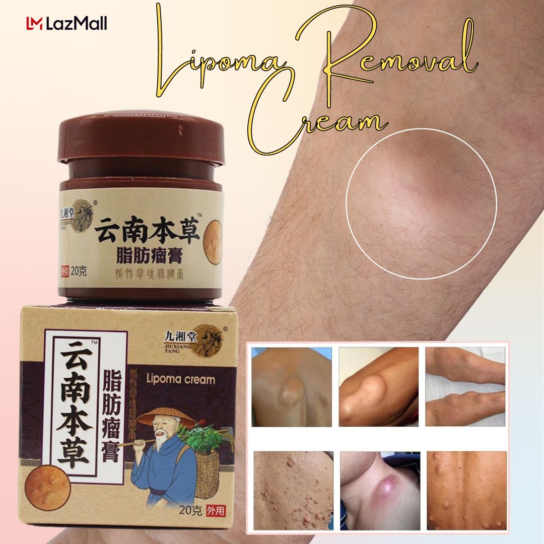 Lipoma Cream Removal Treat Tumor Skin Swelling Ointment Exfoliating ...