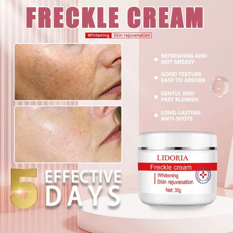 cream for melasma and pekas cream remover original pekas cream eraser ...