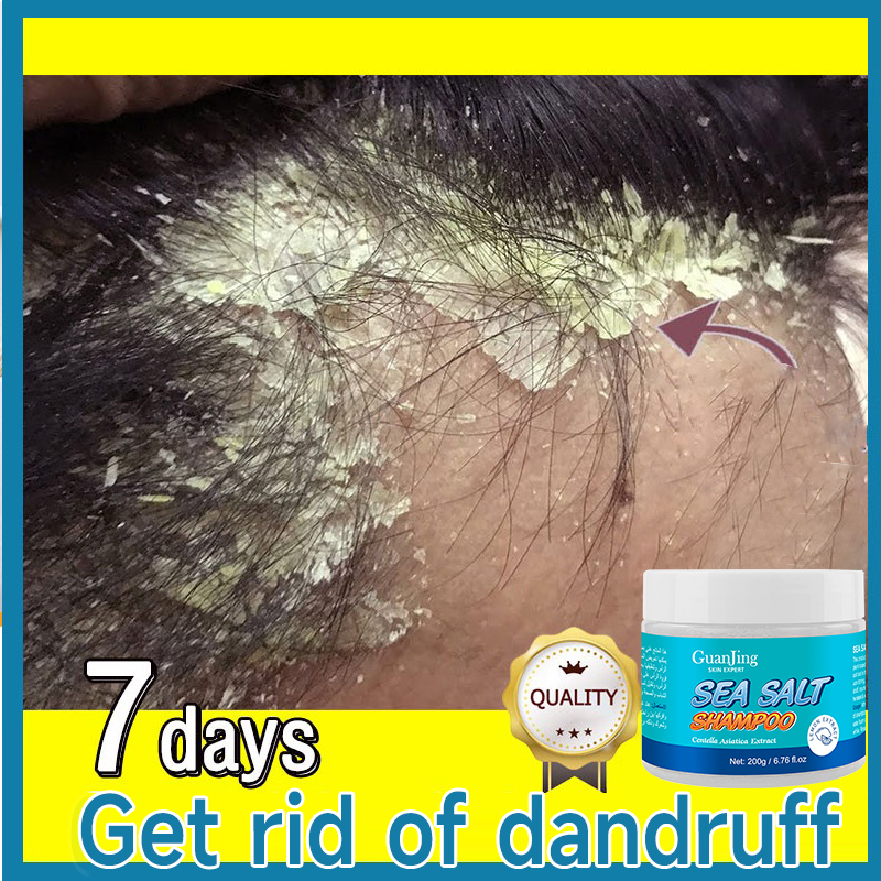 Psoriasis Hair Shampoo Dandruff Remove Treatment Skin Care Dermatitis ...