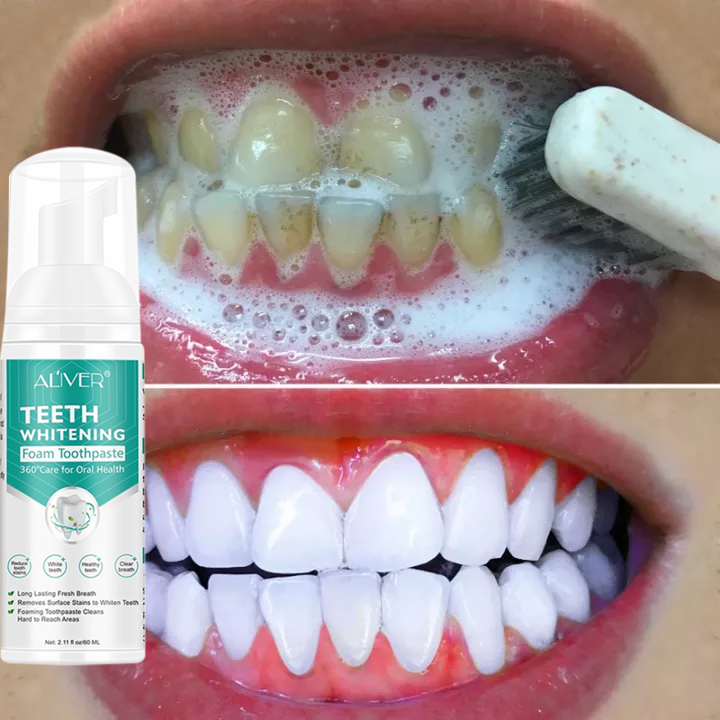 【Effective immediately】ALIVER Teeth Whitening Mousse Toothpaste ...