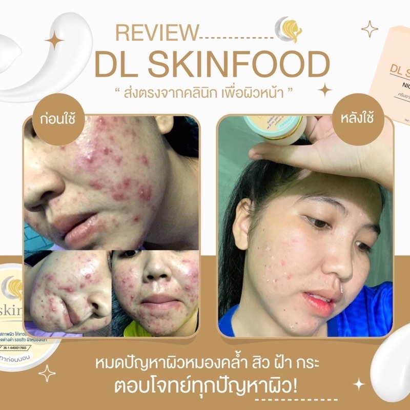 DELI SKIN NIGHT CREAM FOR ACNES/MELASMA/ DULL SKIN FROM THAILAND (5g ...