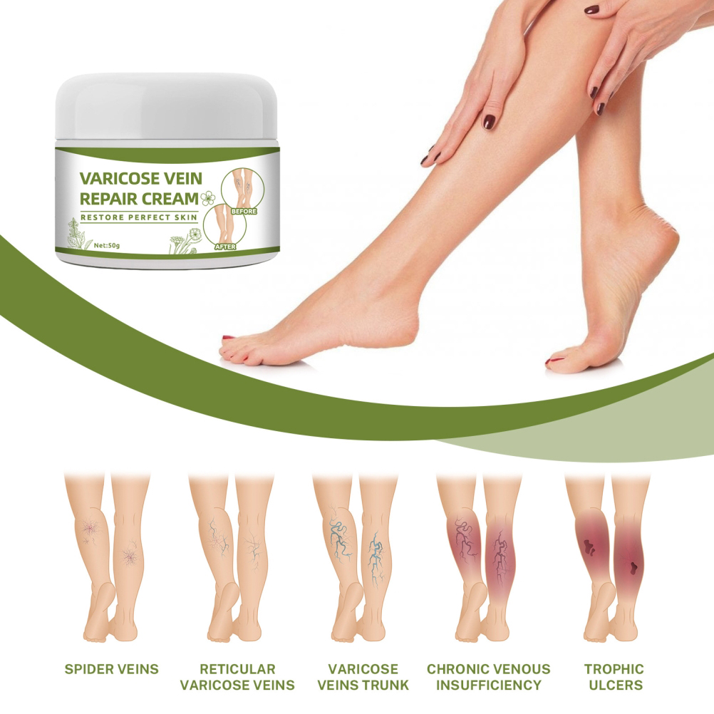 Varicose Vein Cream to Promote Blood Circulation and Tighten Skin Leg ...