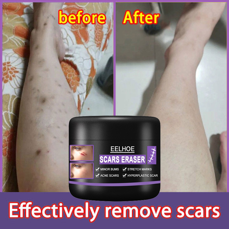 50g EELHOE Scar Cream Original Scar Remover Peklat Remover Cream Original Acne Scar Remover ...