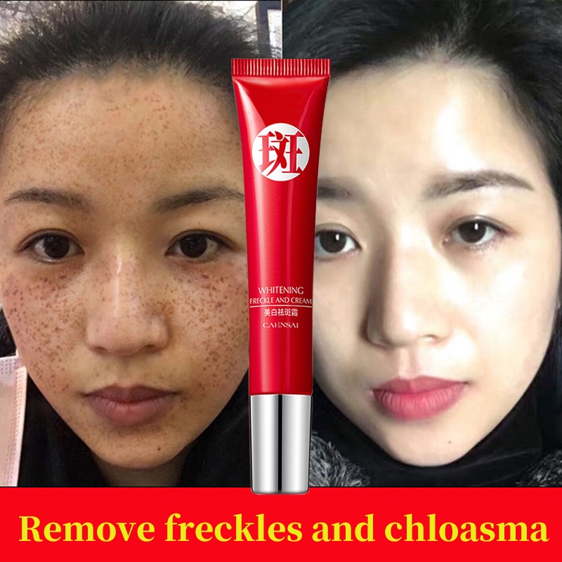 Freckle Removal Whitening Cream Melasma and Pekas Remover Anti Melasma ...