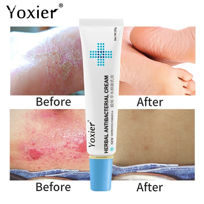Yoxier herbal antibacterial cream Eczema Ointment Psoriasis Cream Anti ...