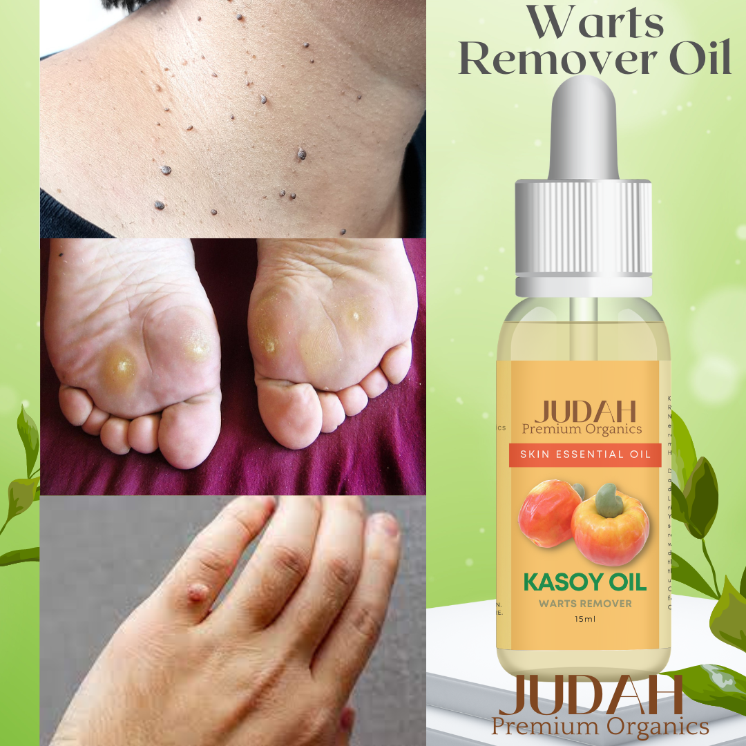 Mole & Warts Remover Kasoy Oil | Magic Warts Remover | , Effectively ...