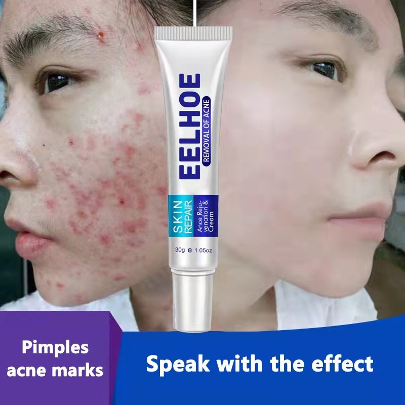 acne remover acne cream pimple remover Pimple Scars Remover Skin Care ...