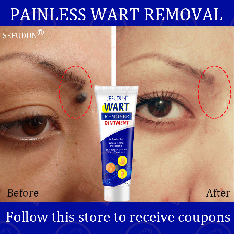 100% Effective Warts Remover Original Skin Growth Warts Remover ...