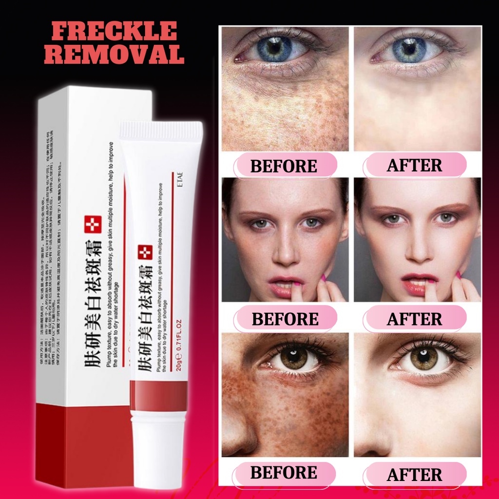 Melasma Face Pekas Remover Original Freckles | Lazada PH