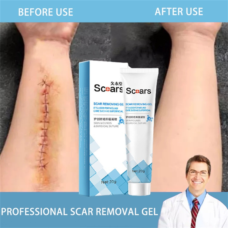 Scar Removal Cream Peklat Remover Acne Treatment Scar remover cream ...