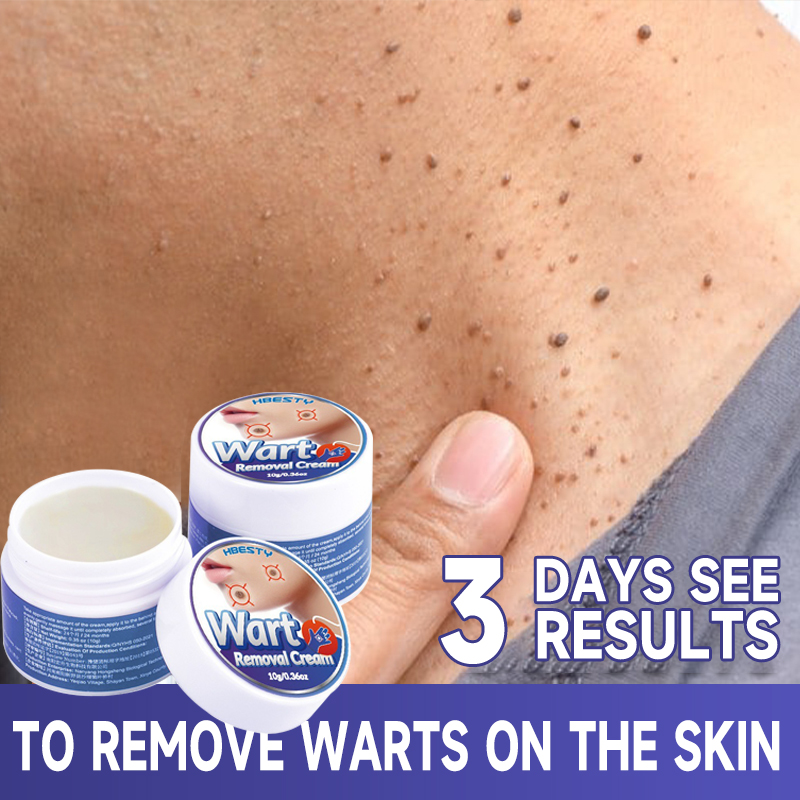 Warts Remover Original Cream Warts Magic Remover Wart Ointment Original ...