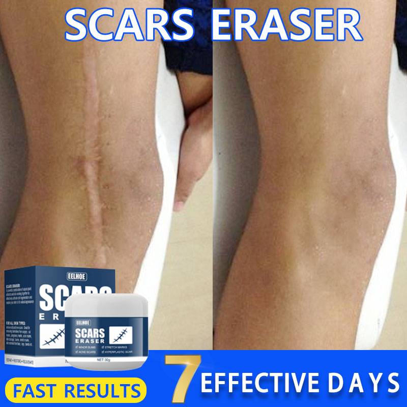 fix scar removal original scar remover for old scar on leg strechmark ...