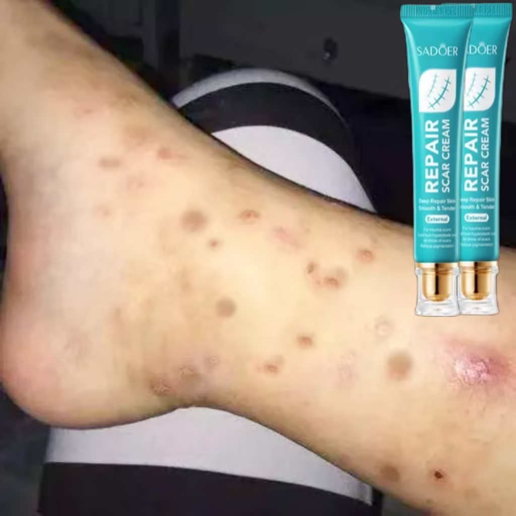 scars remover for old scars Scar Remover scarminator cream original ...
