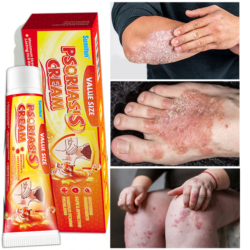 【COD】【Sumifun】Eczema Treatment Cream gamot sa kati kati sa balat buni ...