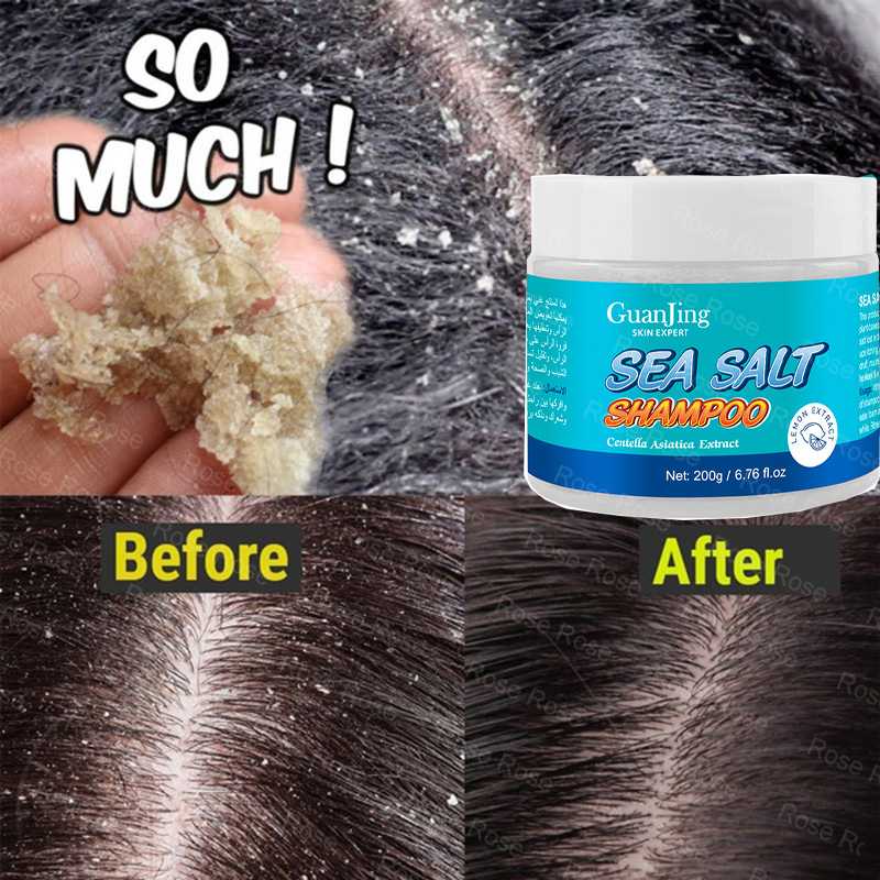 Anti-dandruff shampoo dandruff remover anti fungal No.1 china Authentic ...