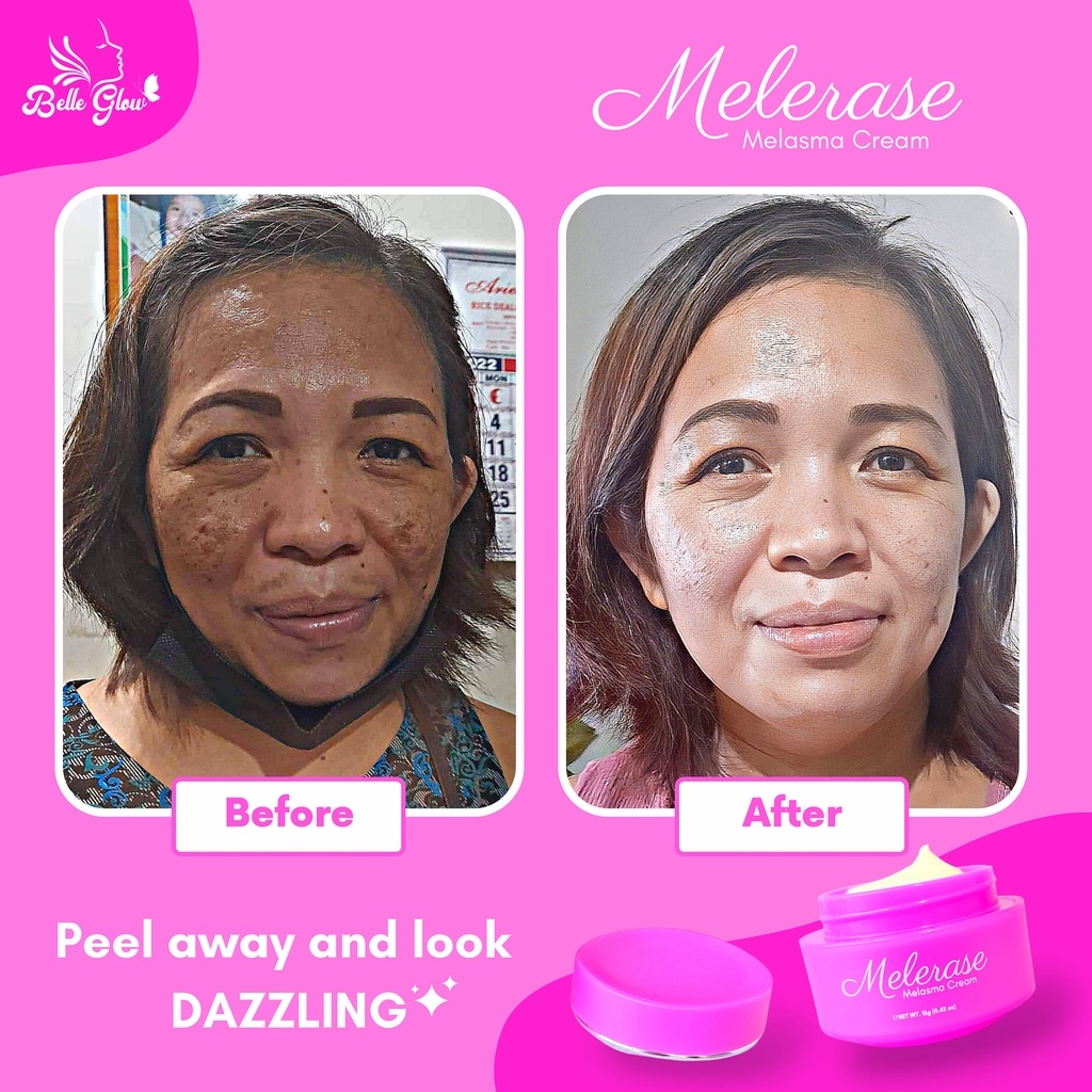 【COD】 MELASMA CREAM Belle Glow skin melerase (melasma and pekas remover ...