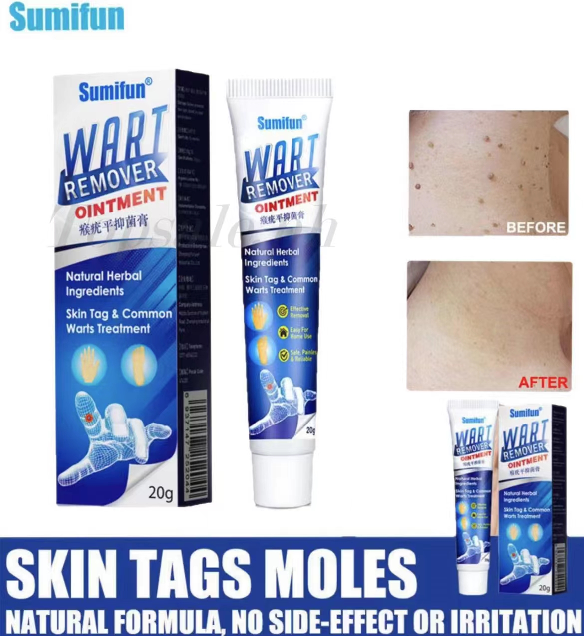 【SUMIFUN】Warts Remover Original Cream Warts Magic Remover Wartz Removal ...