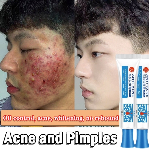 100% Effective Remove Pimples Quickly Pimple Remover Acne Cream Fades Acne Marks Repairs Acne ...