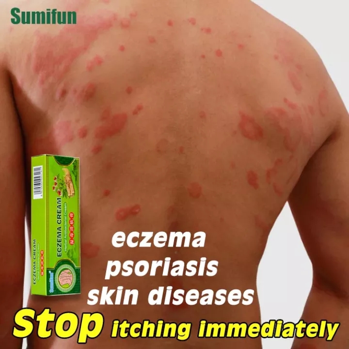Effective Sumifun Eczema Treatment Cream gamot sa kati kati sa balat ...