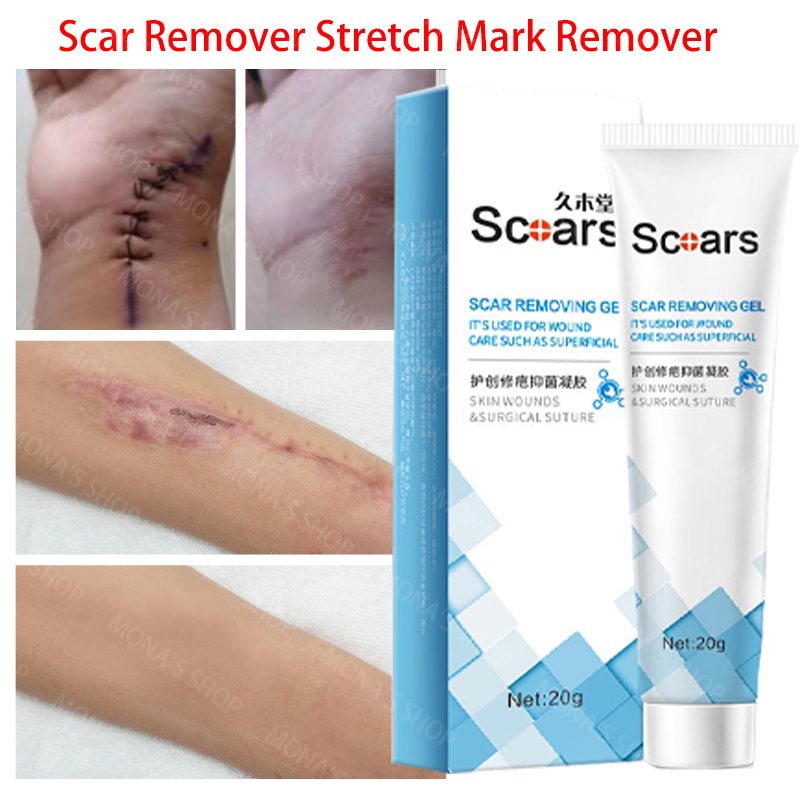 Scar Remover Stretch Mark Remover Old Scar Remover Super Effective Scar ...