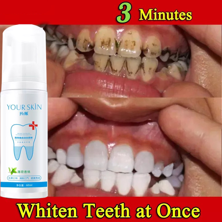 【COD】Teeth Whitening Mousse Toothpaste Oral Hygiene Remove Stains ...