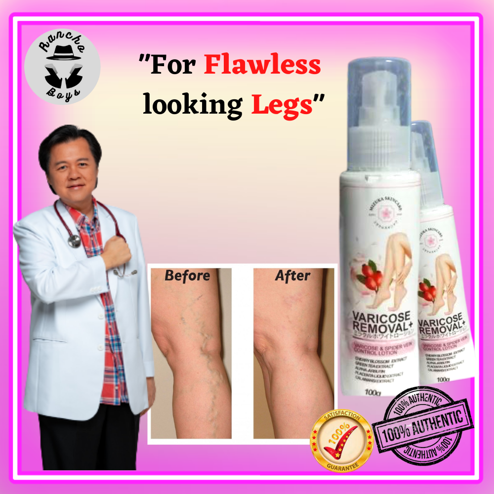NEW MIZUKA VARICOSE REMOVAL |Gamot sa varicose|BARICUS | Spider veins ...