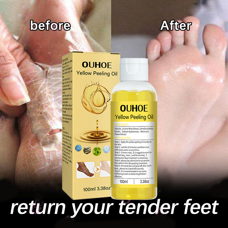 OUHOE 100ml Yellow Peeling Oil Lightening Exfoliating Skin Peeling Body ...