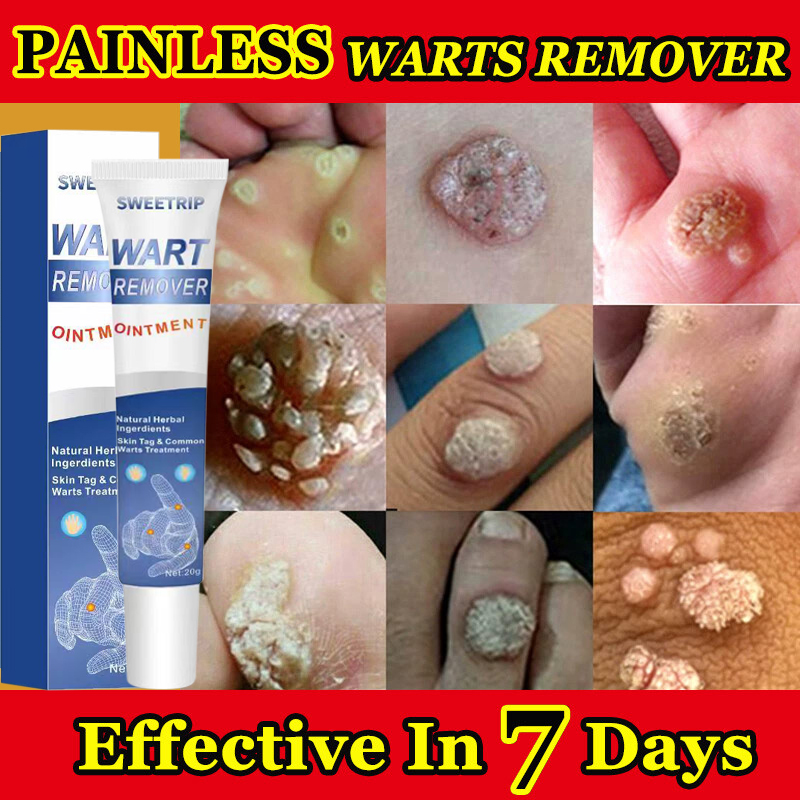 Warts Remover Original Cream Warts Magic Remover Wart Ointment Original Wart Removal Cream Warts ...