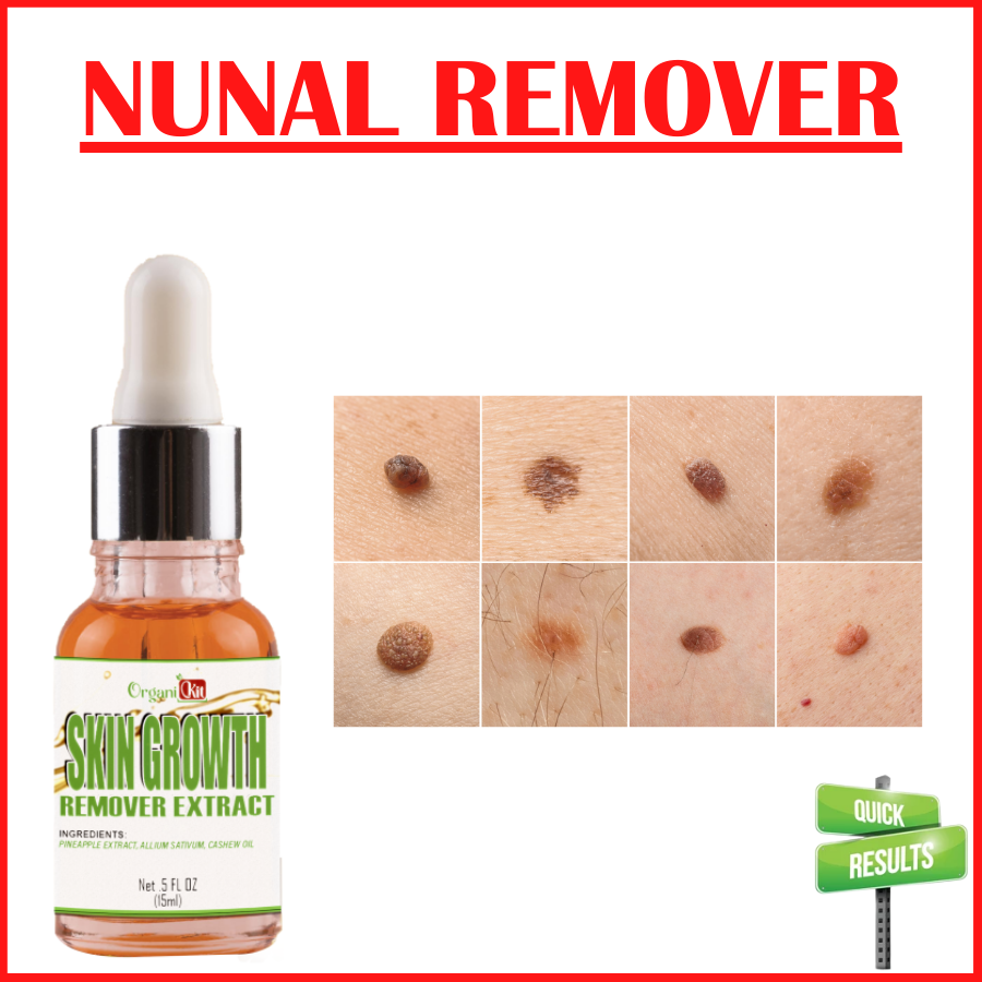NUNAL REMOVER Skin Growth Remover Extract , nunal removal cream ...