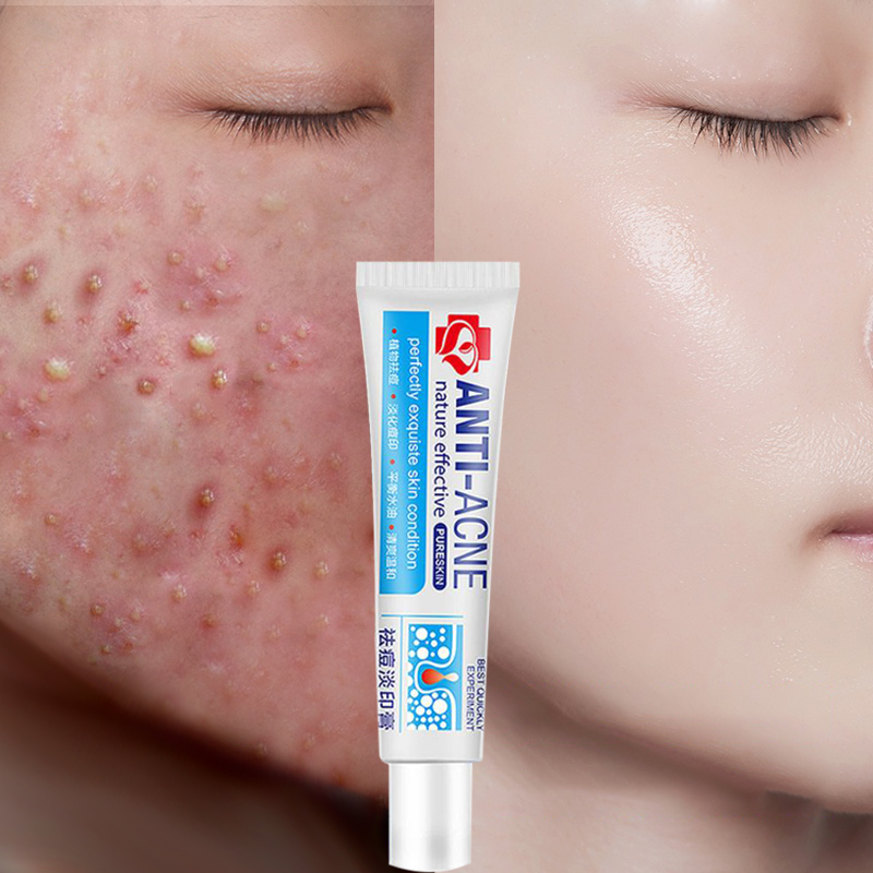 Remove Pimples Quickly Cream Fades Acne Marks Repairs Acne Pits Facial ...