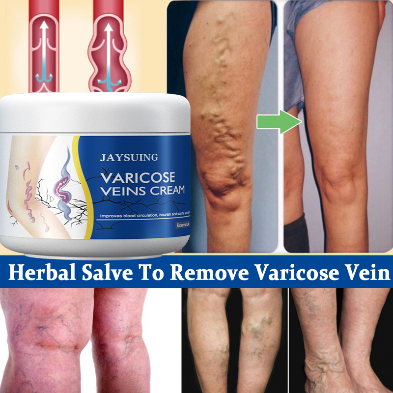JAYSUING Varicose Vein Cream 50g Varicose Vein Ointment Relieve ...