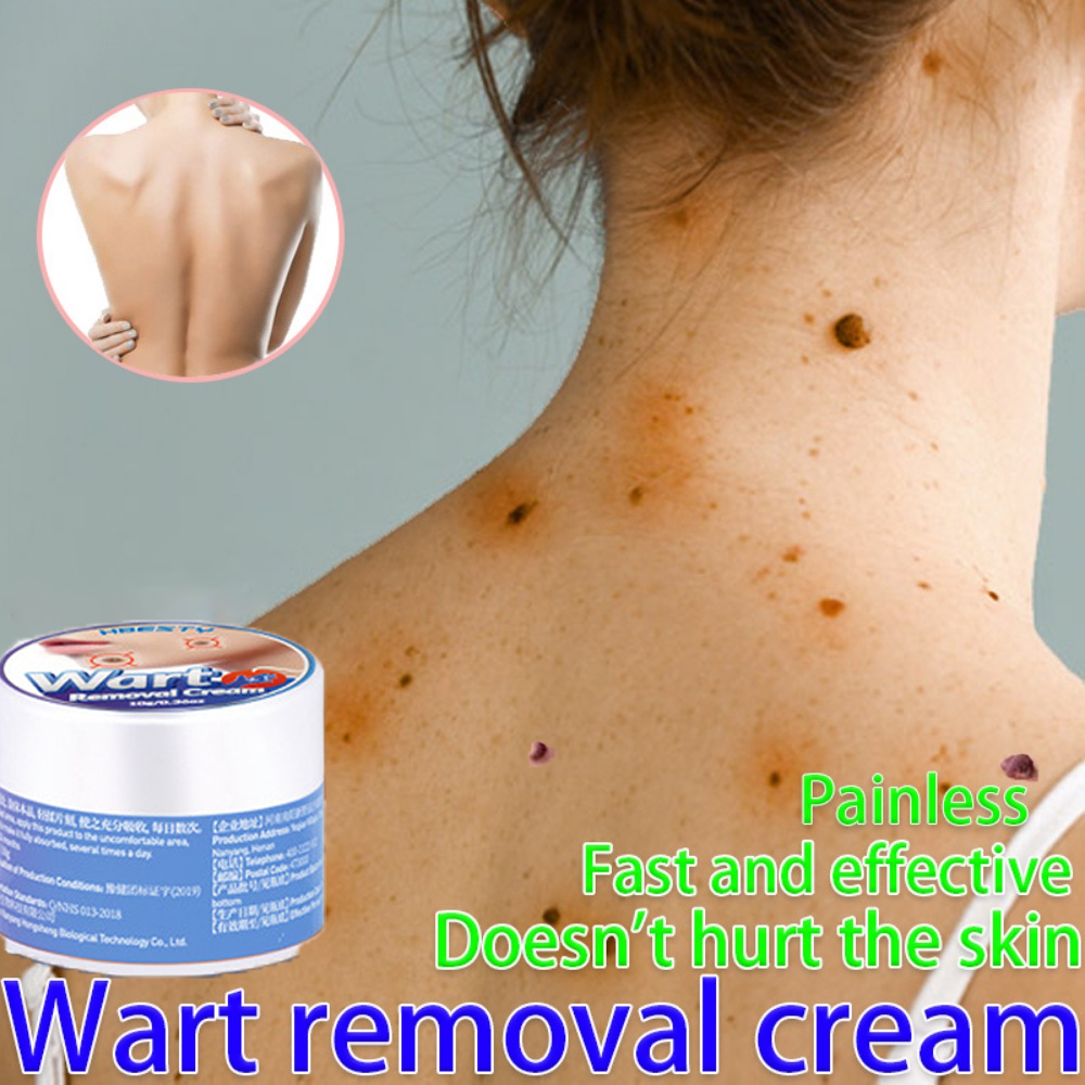 Warts Remover Original Cream Wart Remover Ointment Warts Treatment ...