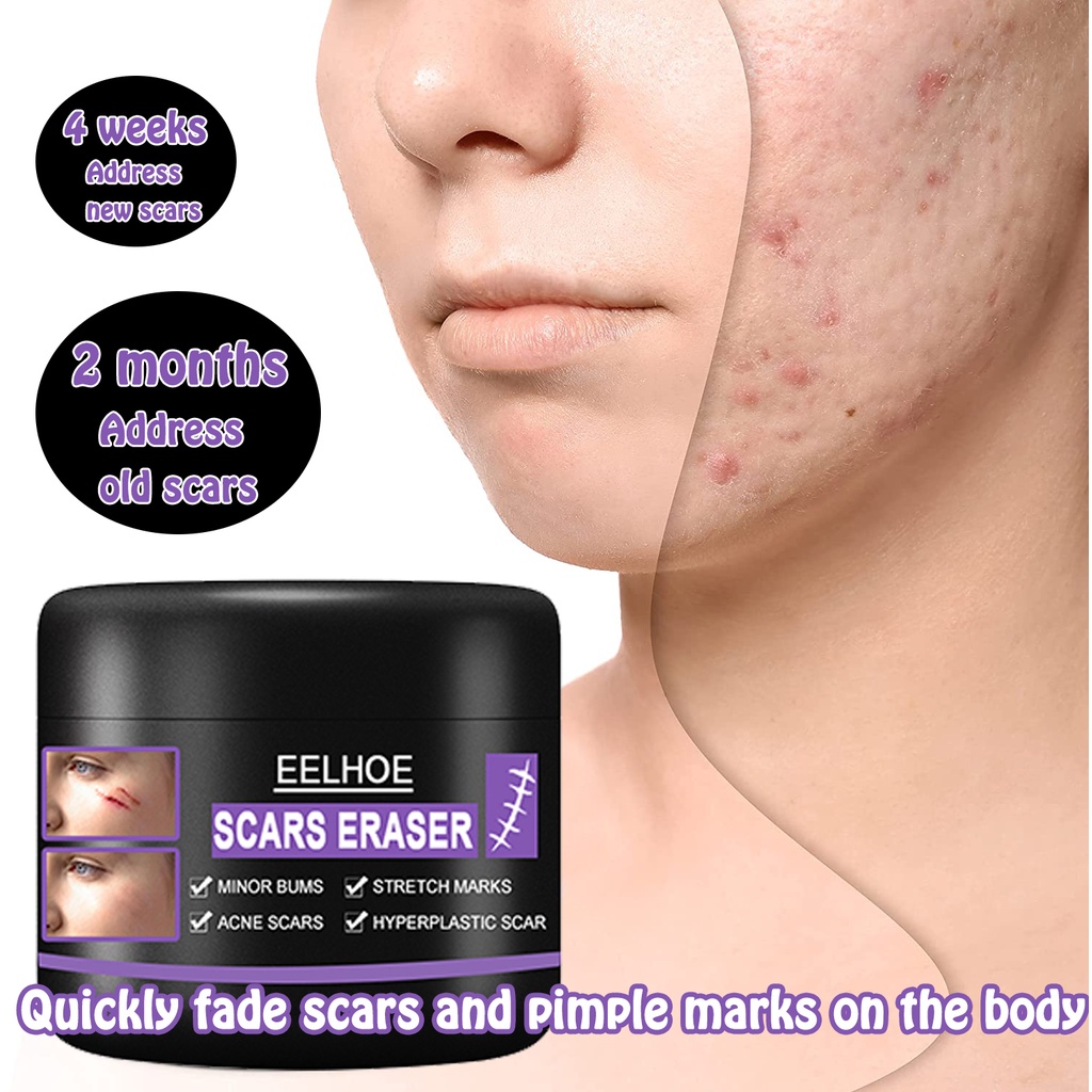 Scar Repair Cream 50g Can For Face Scar And Acne Mark Removal Gel ...
