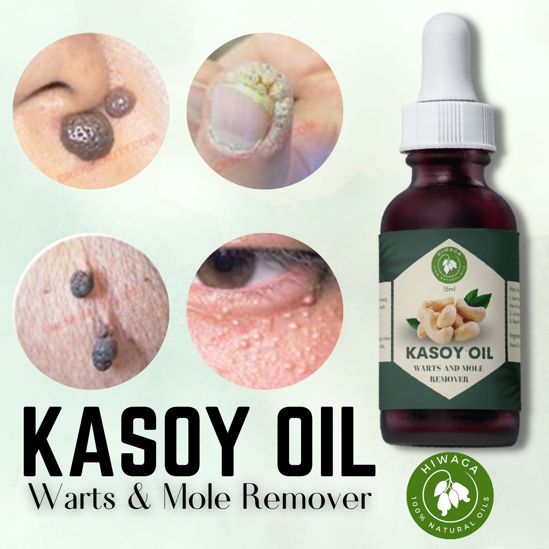 📌Organic Legit Kasoy Oil 15ml Warts, Moles, Kulugo, Nunal & Skin Tags ...