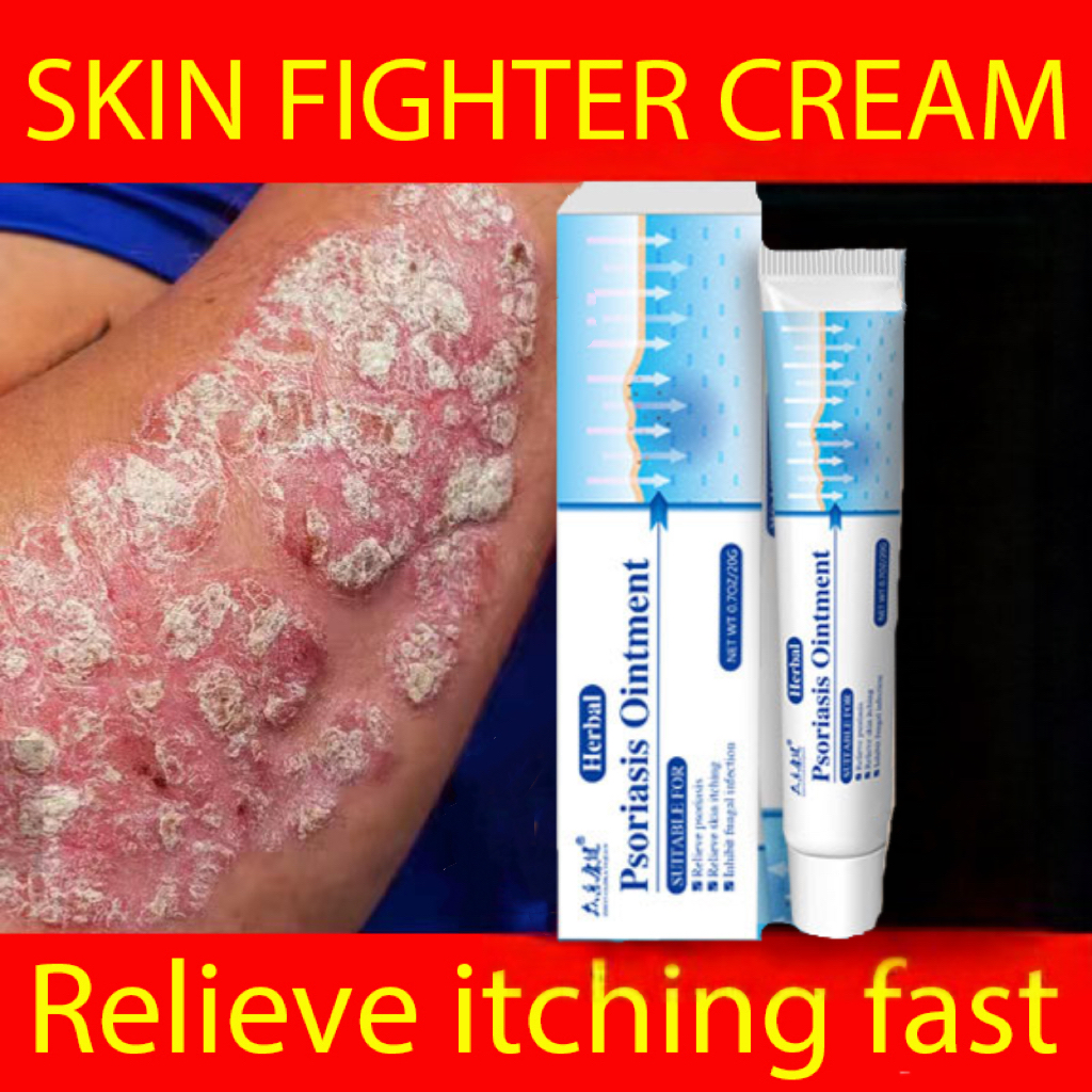 Psoriasis Ointment Eczema Treatment For Itchy Skin and Allergy ...
