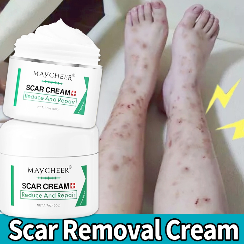 Scar remover peklat remover cream Scars Bakokang Peklat Safe ...