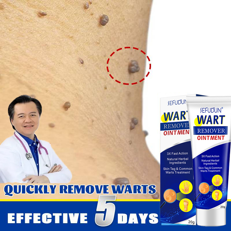 Warts Remover Original Cream painless 20g Warts Magic Remover moles ...