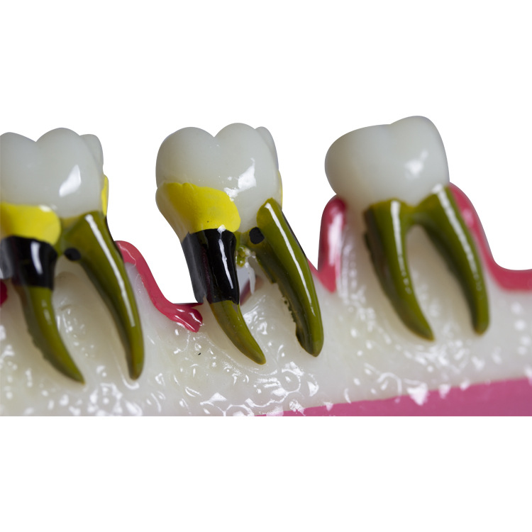 Dental Dental Decay Model Pit and Ditch Closed Model Tooth Decay ...