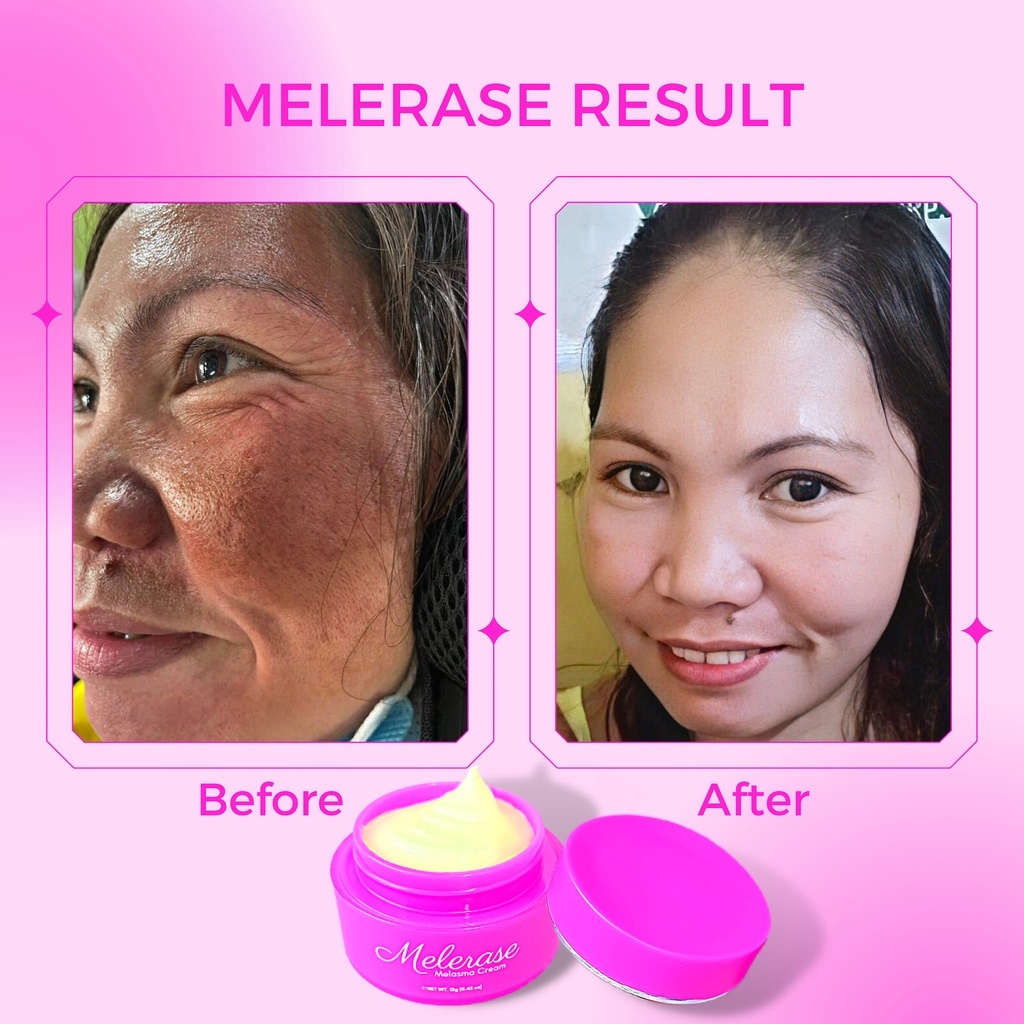 MELASMA CREAM Belle Glow skin melerase (melasma and pekas remover) by ...