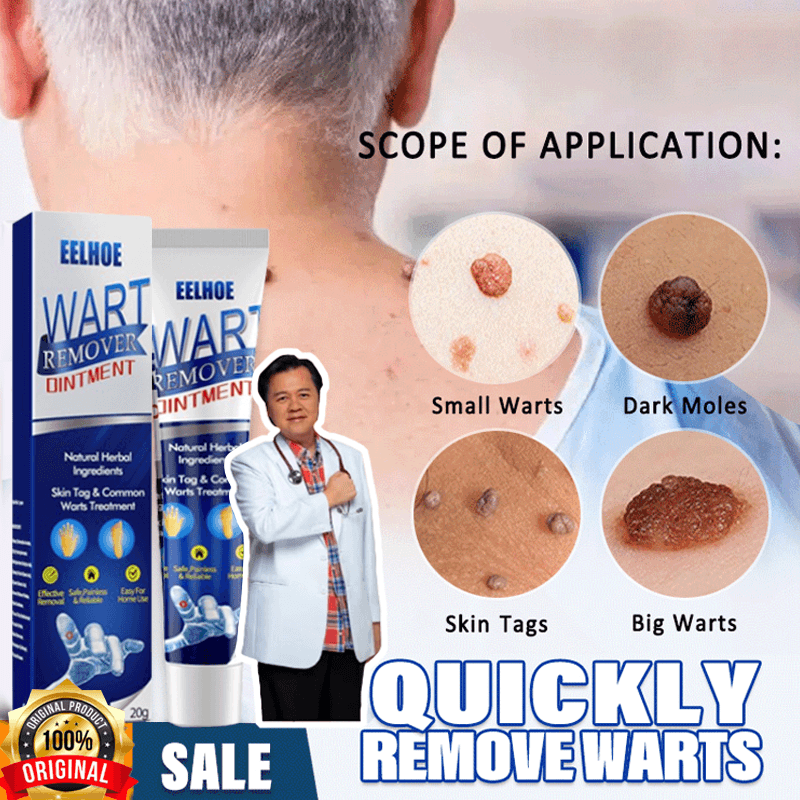 POC warts remover original watson warts removal skin tags and warts ...