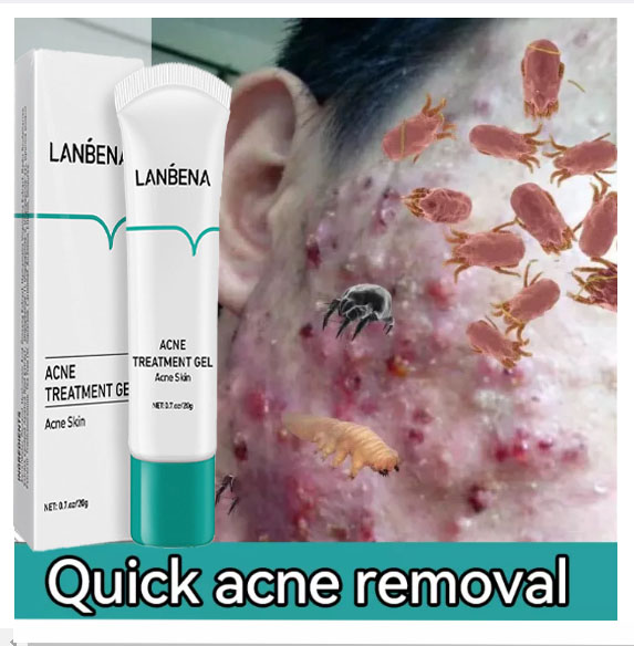 LANBENA Herbal Acne Treatment Gel Acne Acne Removal Cream Acne Gel ...